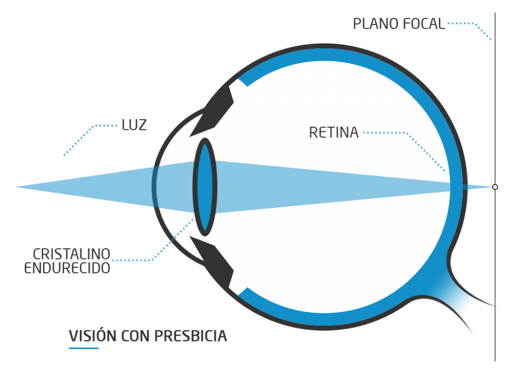 Presbicia - Dr. Arasanz